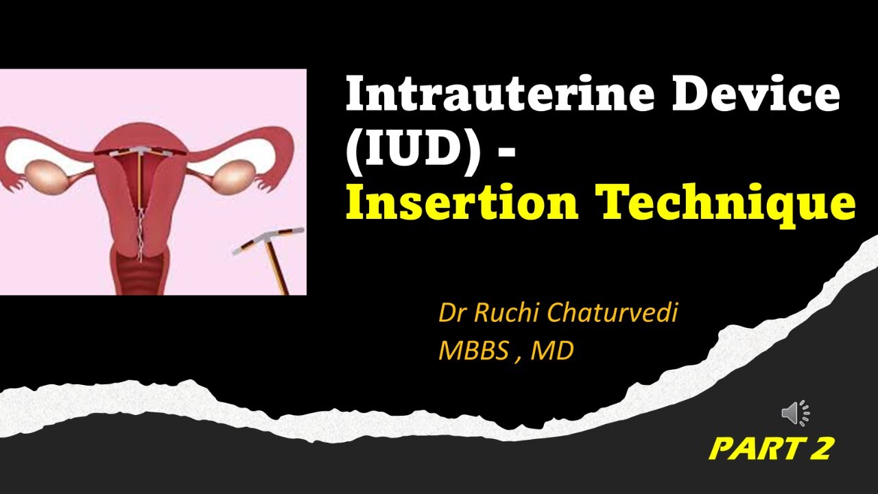IUD Insertion Step-by-Step | No-Touch Withdrawal Technique Explained ...