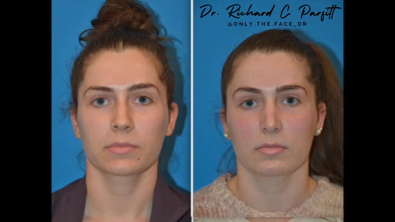 Will scars be noticeable after Rhinoplasty (nose surgery)? - YouTube