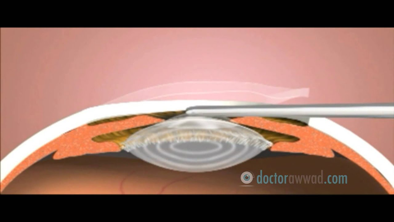 Implantable Corrective Lenses (ICL) (English) - YouTube