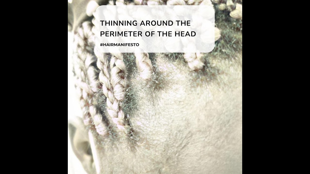 Hair Thinning Around the Perimeter of the Head - YouTube