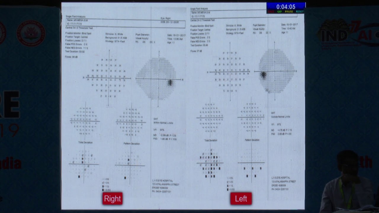AIOC2019 FP 745 Neuro Ophthalmology II TRANSIENT HEMIANOPIA Dr KRITHIKA ...