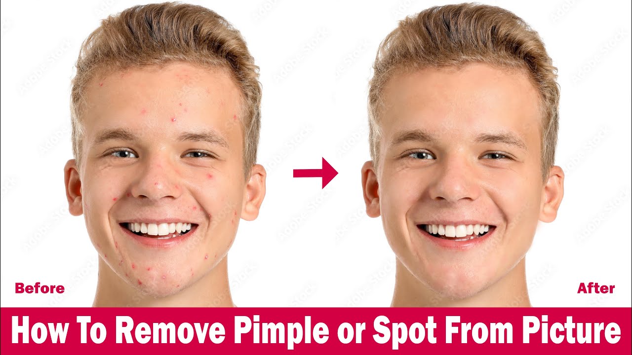 How To Remove Acne - Photoshop Tutorial For Beginners - YouTube