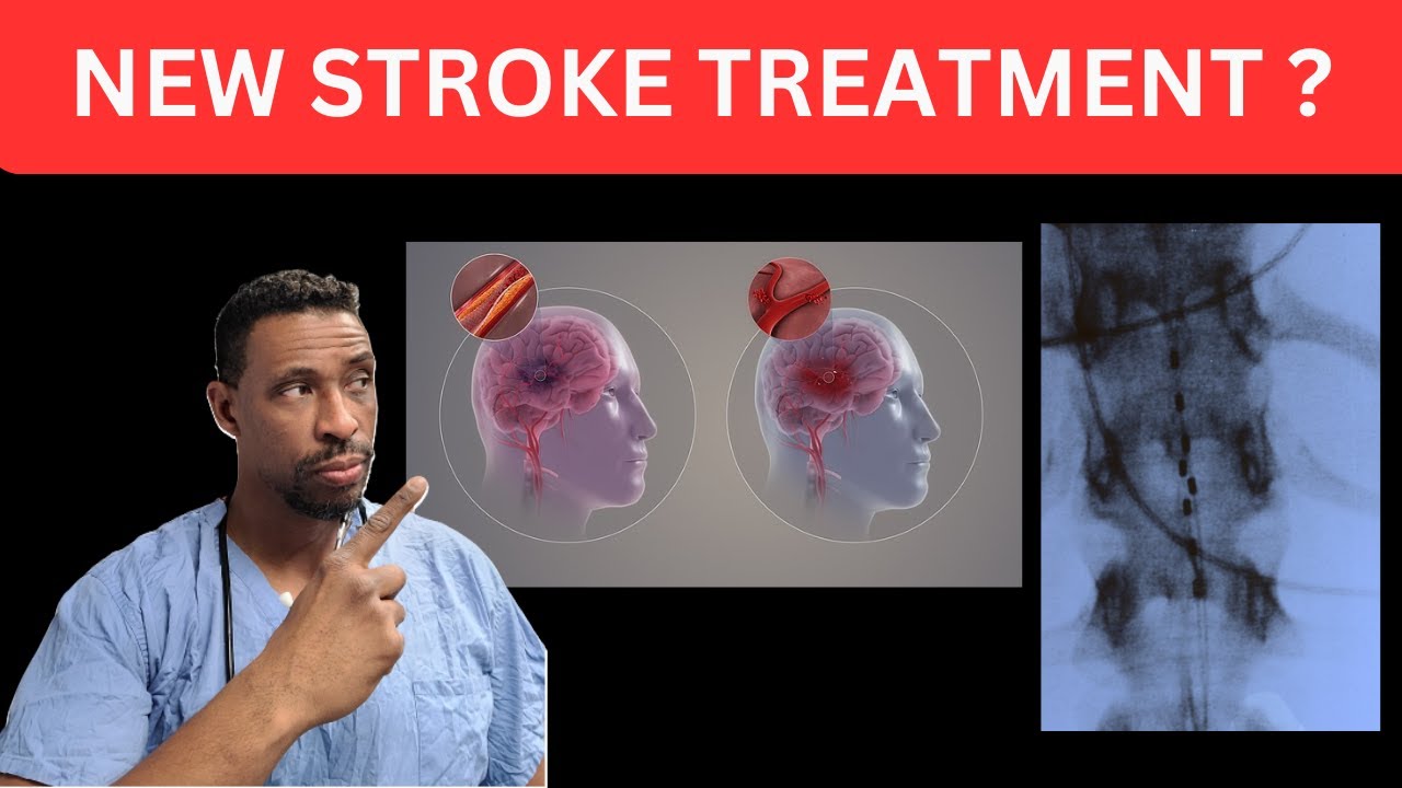 Hope for Stroke Survivors: The Science Behind Spinal Cord Stimulation ...
