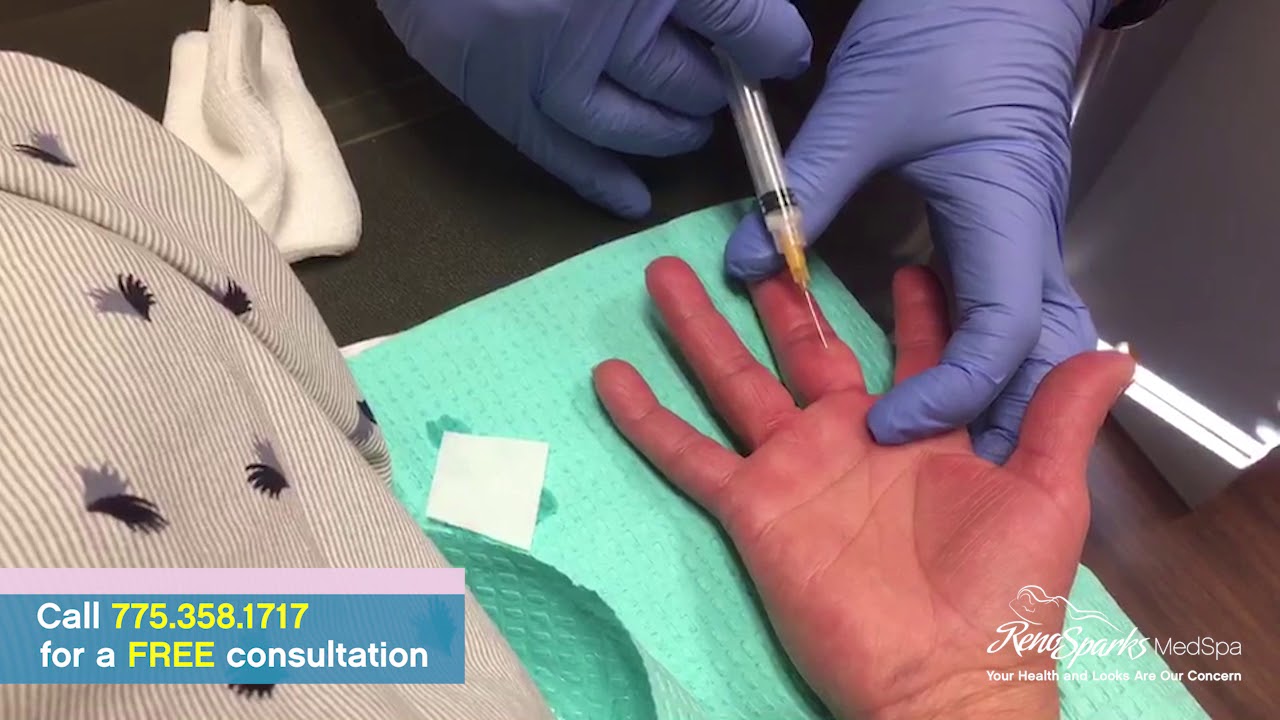 Trigger Finger Injection - Reno Sparks MedSpa - Dr. Calvin Van Reken ...