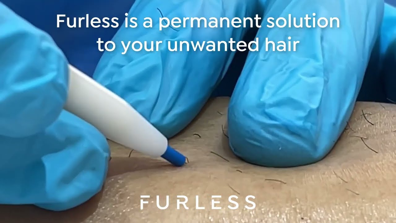 Never Shave Your Legs Again After This Treatment | Furless Permanent ...