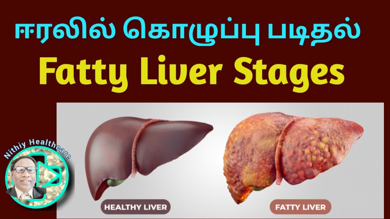 What are the grades of fatty liver?|Nithiyhealthcare - YouTube