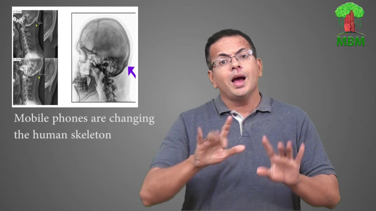 Mobile phones are changing the human skeleton - YouTube