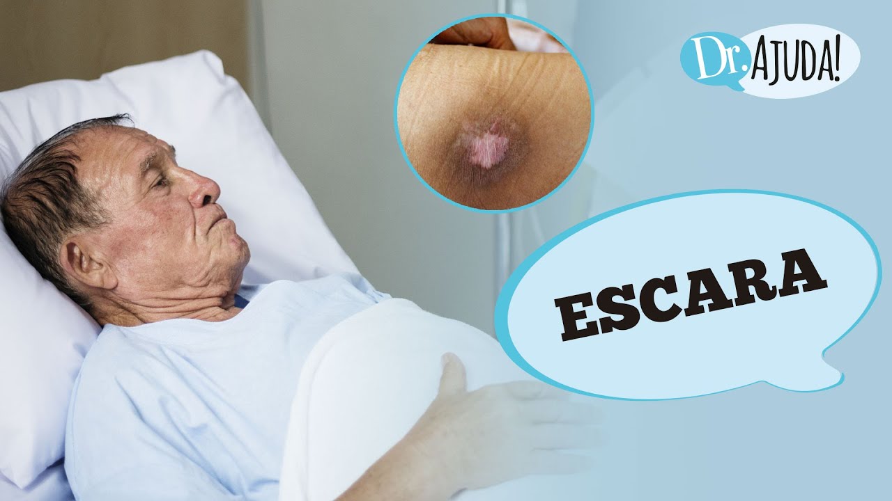 ESCARA: O QUE É? O QUE FAZER QUANDO ISSO ACONTECE? - YouTube