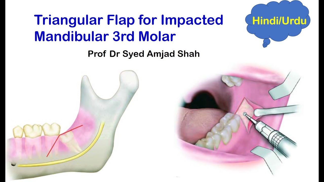 Triangular Flap for Impacted Mandibular 3rd Molar | Hindi/Urdu | Oral ...