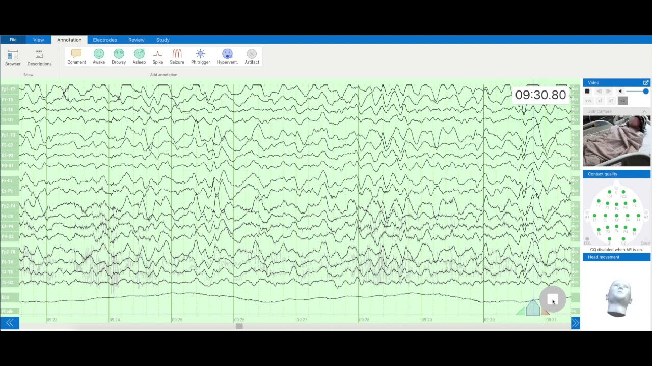 Man Lying Down Hospital Bed Monitored with Zeto EEG - YouTube