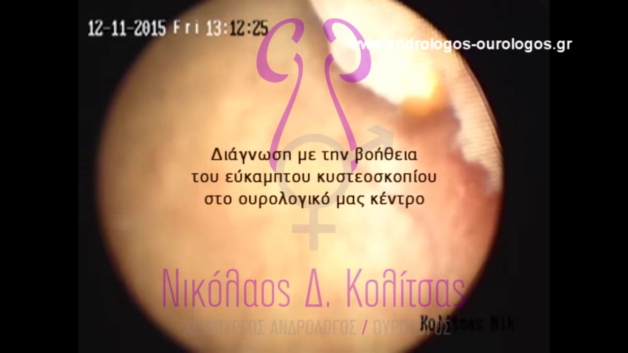 Καρκίνος στην ουροδόχο κύστη (θήλωμα) - YouTube