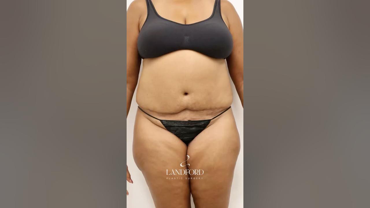 Tummy Tuck Revision // 3 Weeks to 3 Months Recovery! Everyone heals differently! #abdominoplasty ...