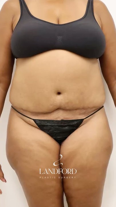 Tummy Tuck Revision // 3 Weeks to 3 Months Recovery! Everyone heals differently! #abdominoplasty ...