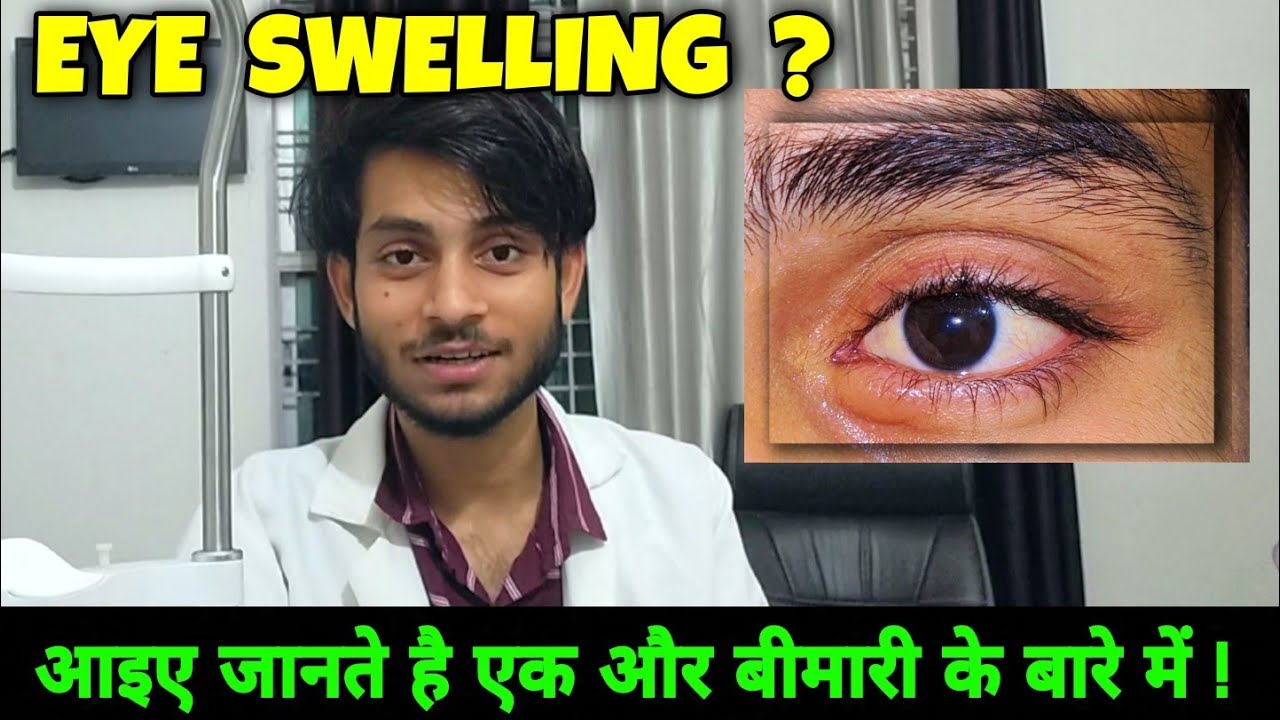 preseptal cellulitis in hindi / preseptal cellulitis / eye swelling in Hindi / eye swelling # ...