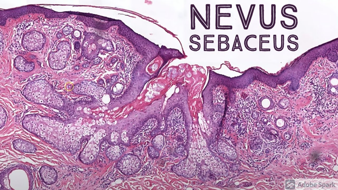 Nevus sebaceus with associated benign hair follicle tumors (not spelled ...