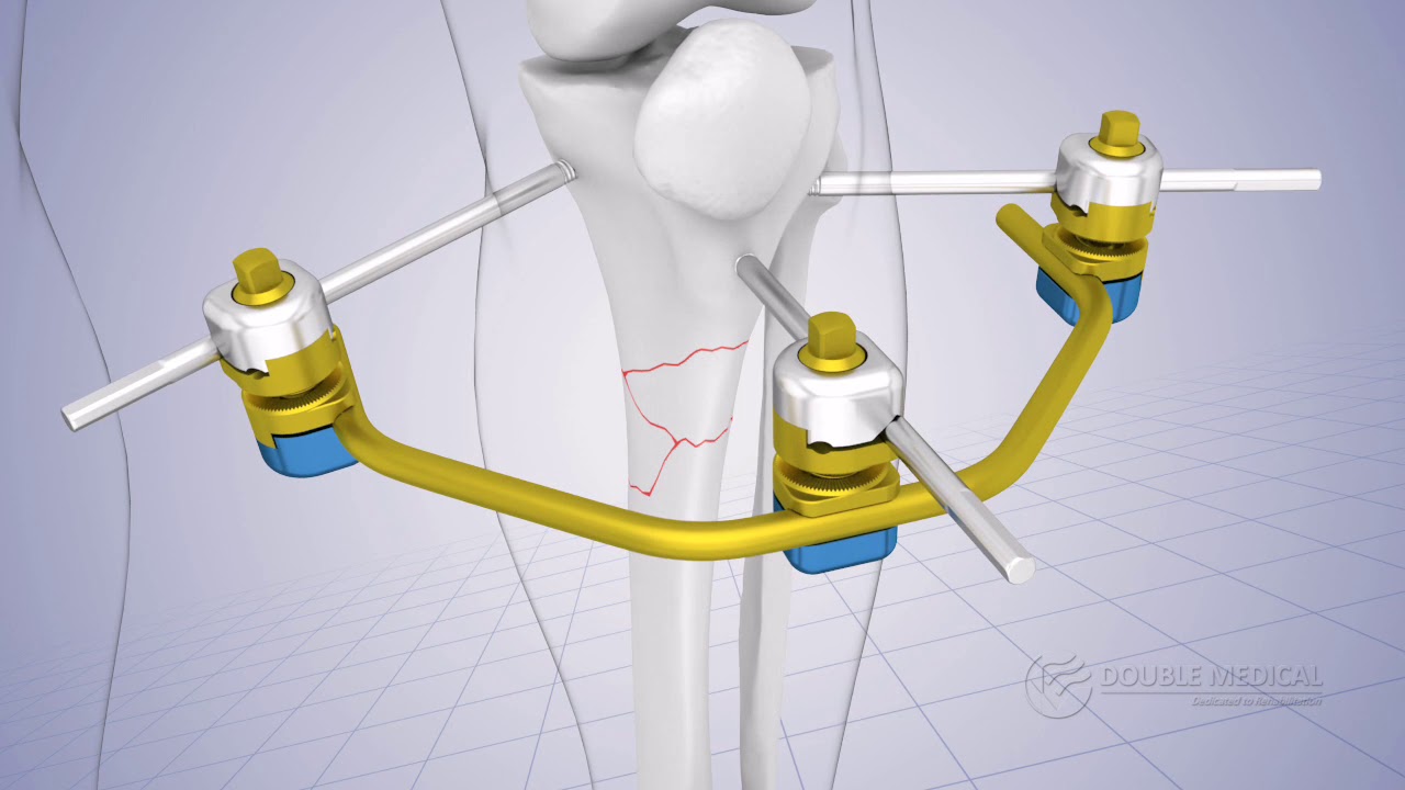 Double Medical SK Combined External Fixator - YouTube