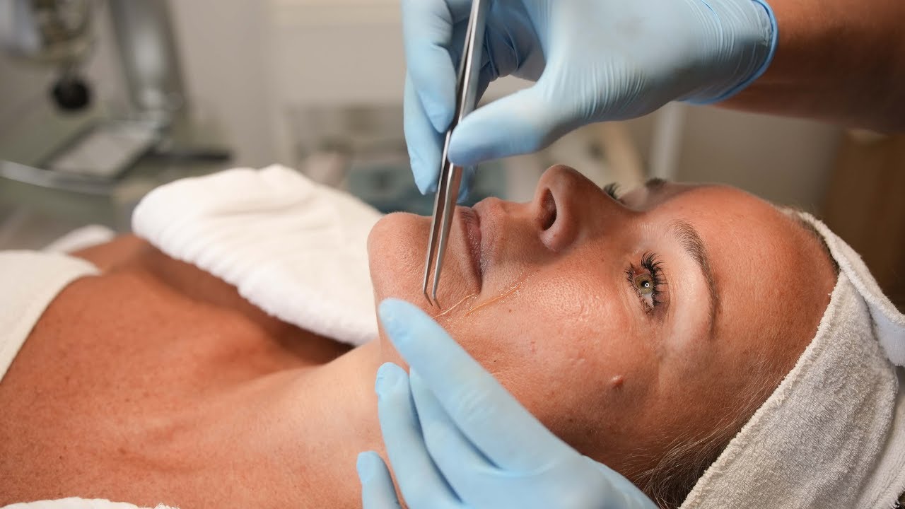 Behandeling uitgelicht: Draadjeslift - YouTube