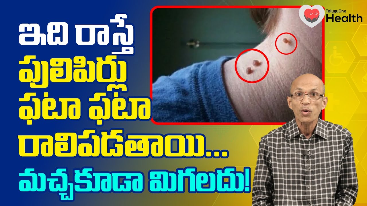 Pulipirlu, Warts | ఇది రాస్తే పులిపిర్లు ఫటాఫటా రాలిపడతాయి Dr Ch ...