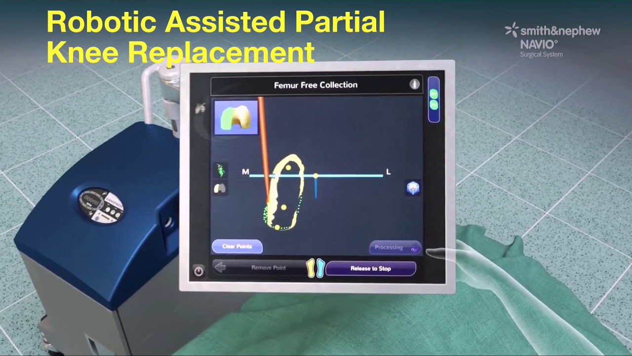 Robotic assisted Partial (Uni-condylar) Knee Replacement (UKR) - YouTube