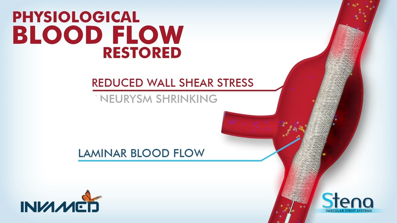 Stena®🦋 Multi- Layer Flow Modulator - YouTube