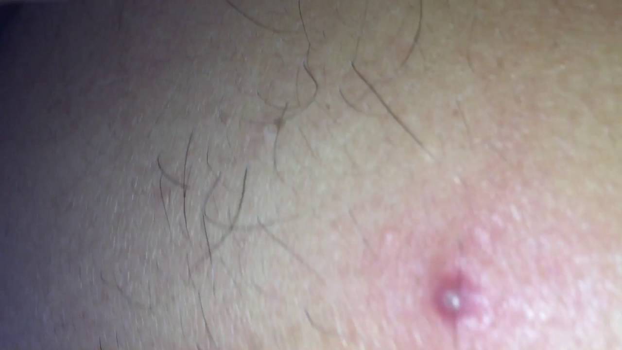 Pimple POP on back - YouTube