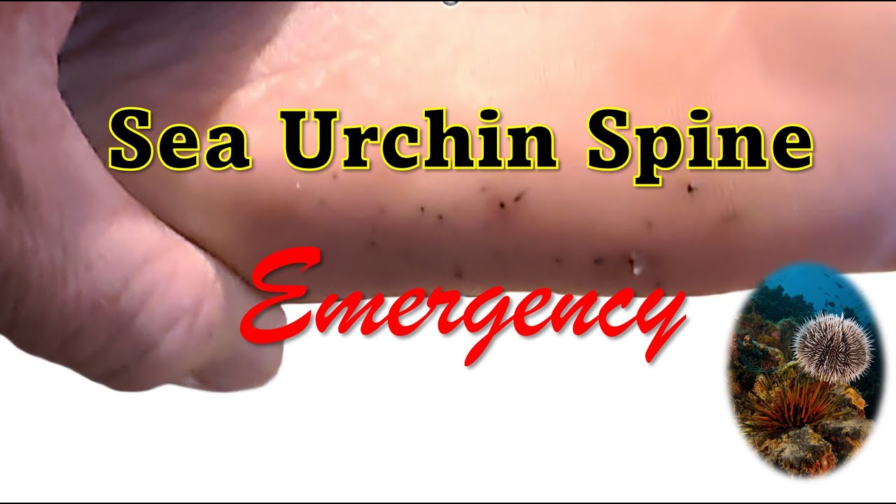 Sea Urchin Spine Emergency in the Dominican Republic - YouTube