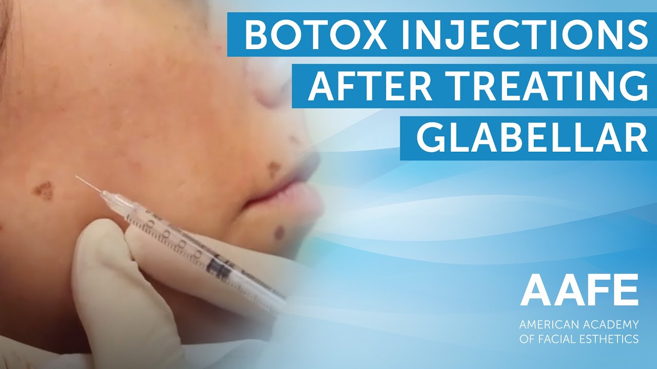 Botox Injections After Treating Glabellar - YouTube
