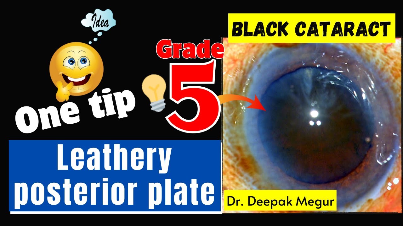 Rock Hard Cataract. One tip to break the thick leathery posterior plate ...