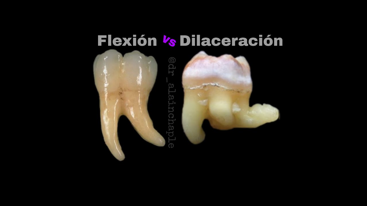 💡 Dilaceración vs. Flexión - ¿Cuál es la diferencia? Te lo explicamos ...
