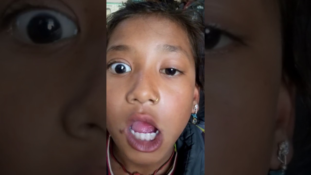 Marcus-Gunn jaw winking (PTOSIS) - YouTube