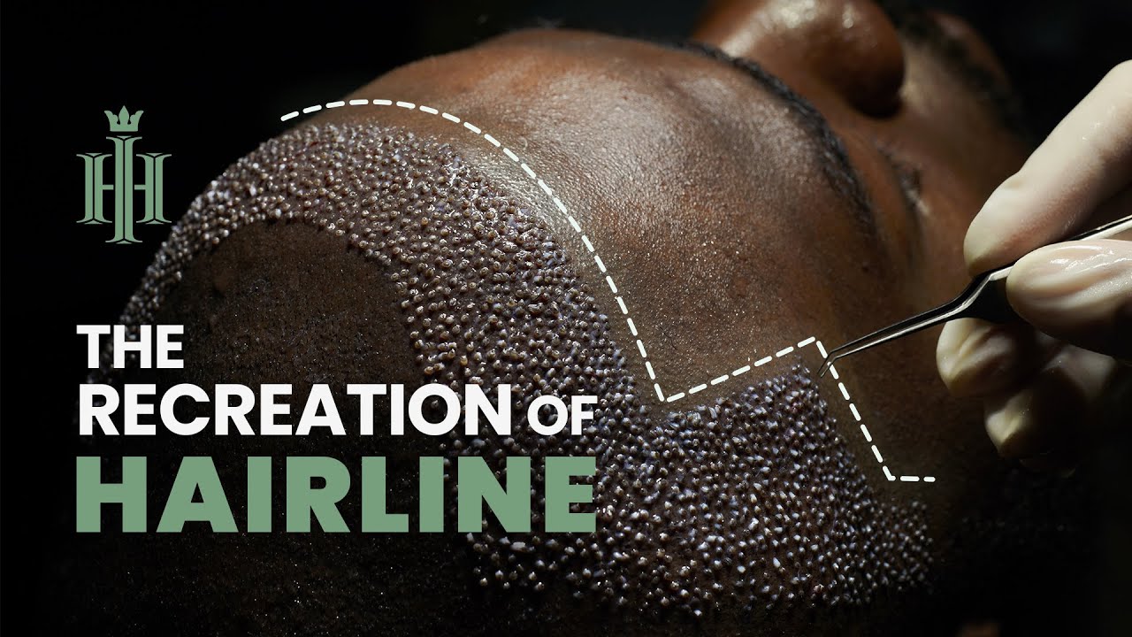 Specialized Hair Transplant for Afro-American Men | "The LeBron James ...