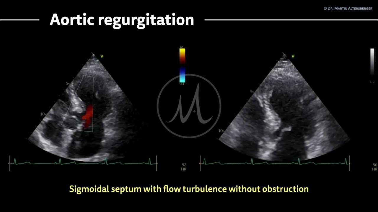 〖echocardiography〗 Sigmoidal Septum And Mild Aortic Regurgitation Youtube