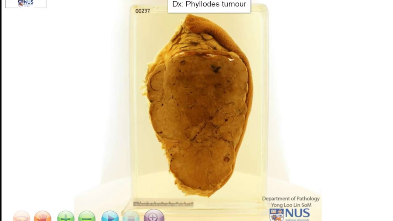 Breast: Phyllodes tumour gross and microscopy - YouTube