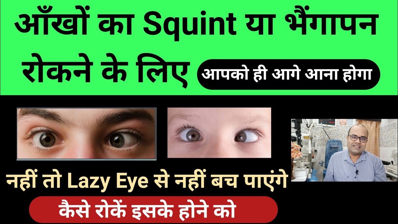 SQUINT TREATMENT - भेंगापन से छुटकारा | STRABISMUS permanent Cure ...