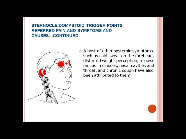 Sternocleidomastoid Trigger Points