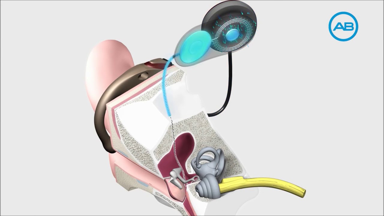 How A Cochlear Implant Works by Advanced Bionics - YouTube