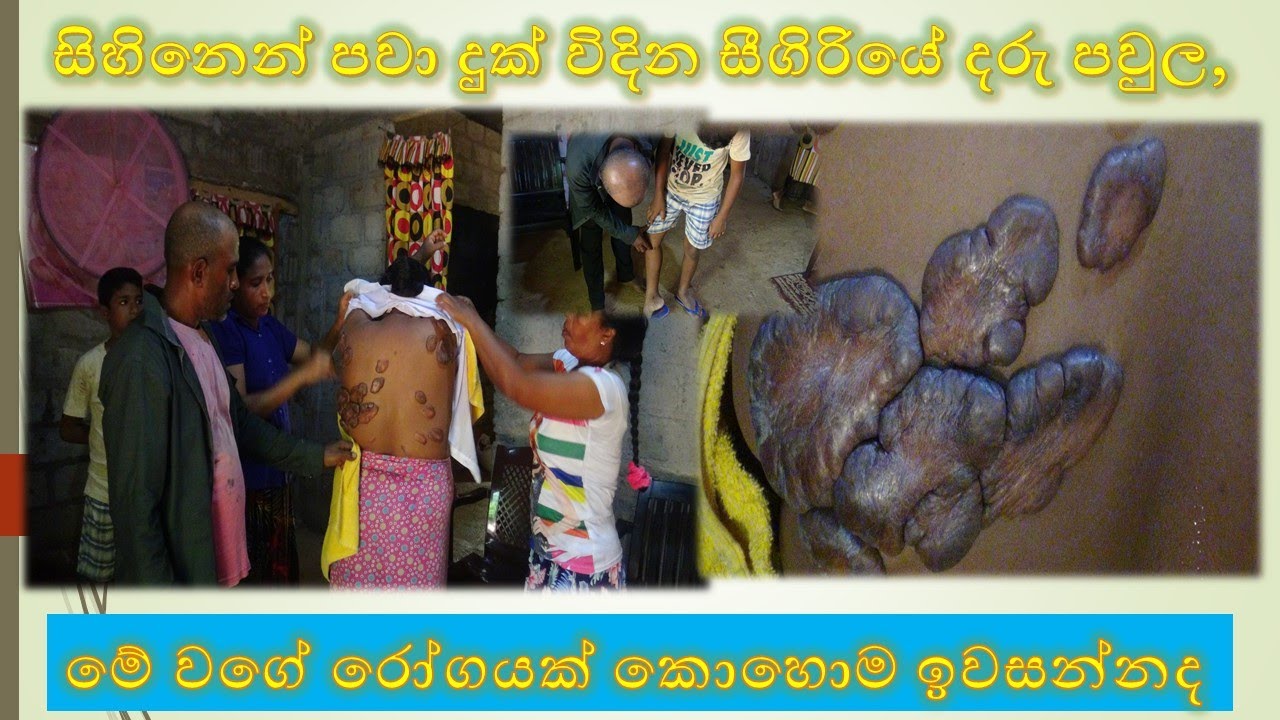 sigiriye same roga kanthawa 01මේ වගේ රෝගයක් කොහොම ඉවසන්නද - YouTube