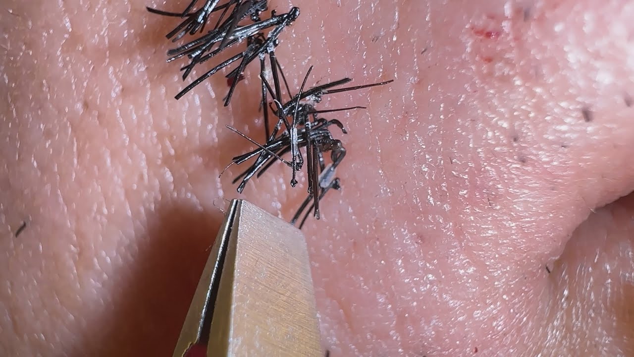 Plucking facial hair 949 口髭抜き - YouTube