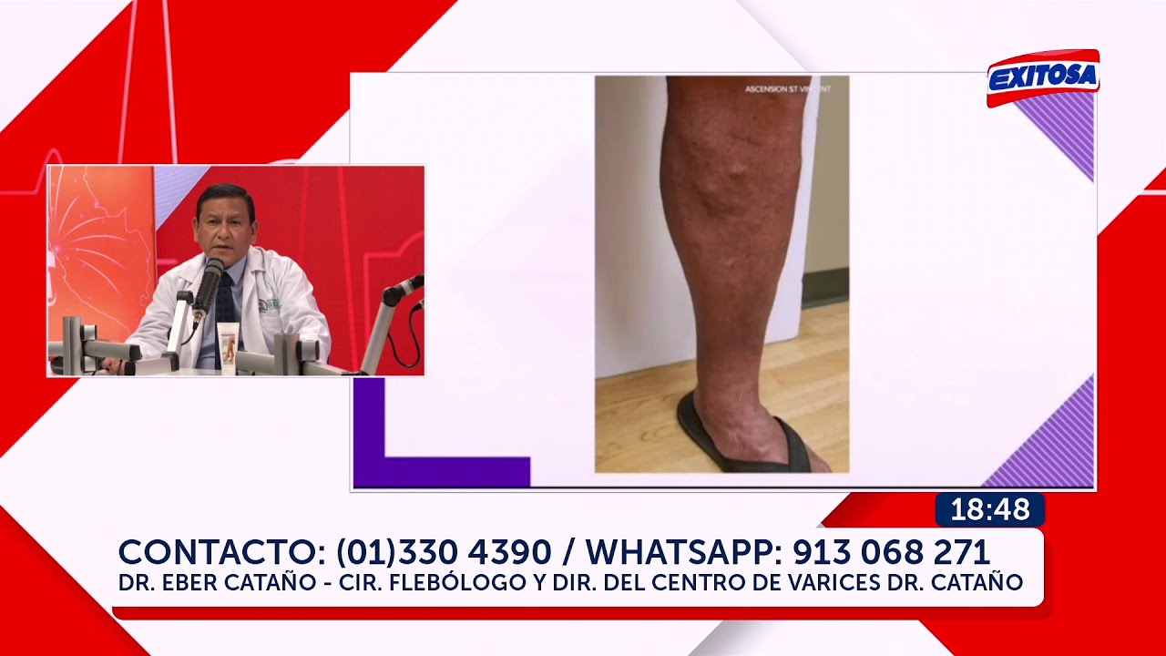 Dr. Eber Cataño en Exitosa - Tratamientos para Várices, diferencias ...