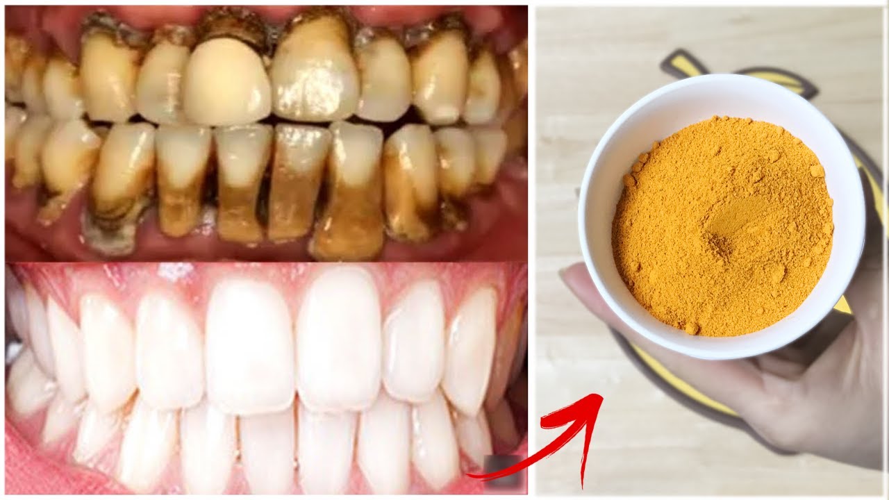Teeth whitening in seconds || How to whiten your yellow teeth at home ...