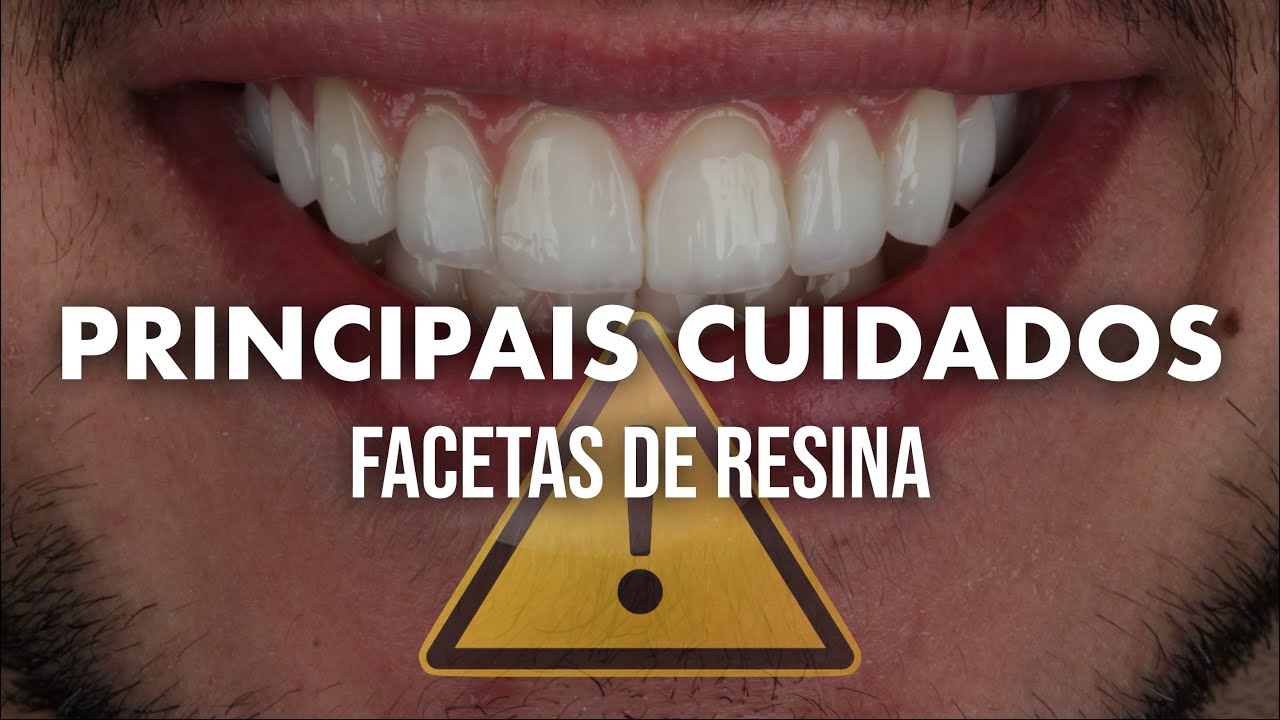 Quais são os cuidados com as Facetas de Resina Composta? - YouTube