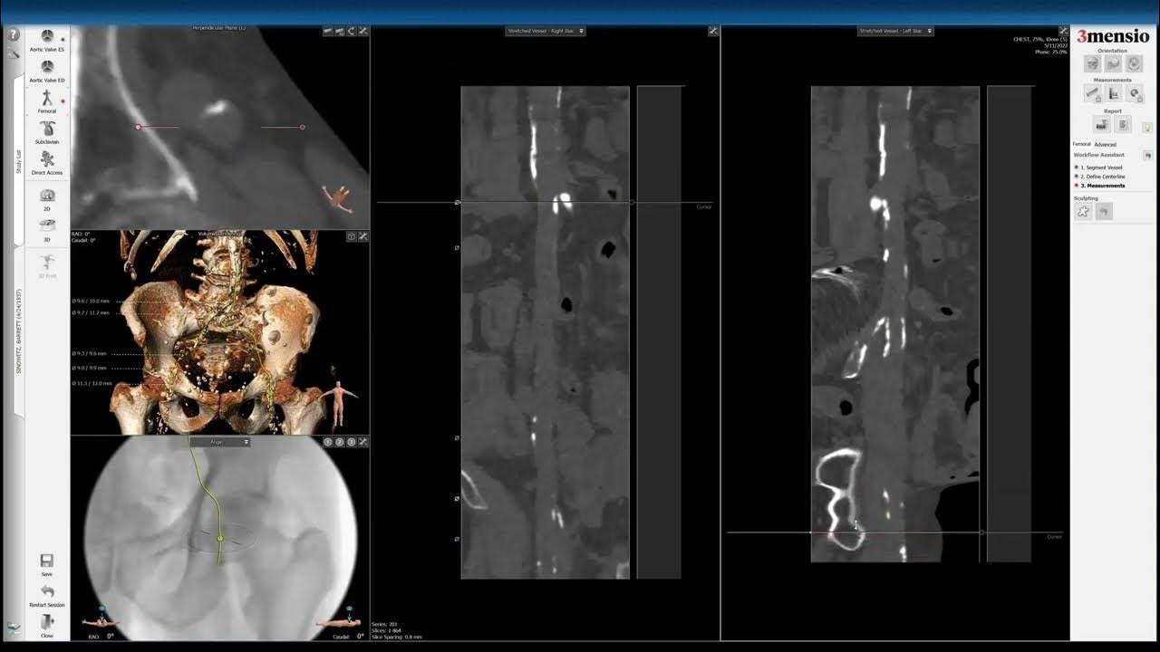 3Mensio CT Pre-case Planning: TAVR femoral access workup (non-contrast CT) - YouTube