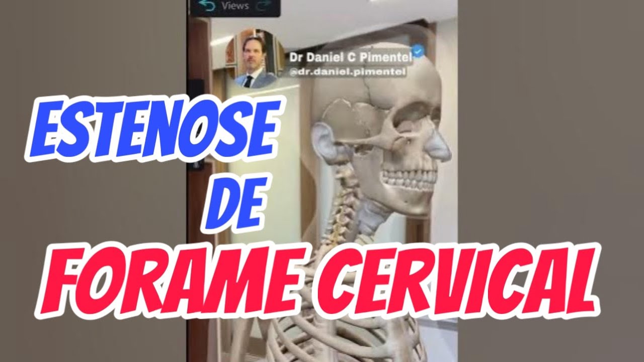 Estenose Foraminal : O Que Fazer? – YOUG