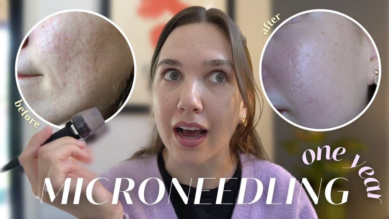 What ONE YEAR of Microneedling Did To My Skin... | Acne Scarring Before ...