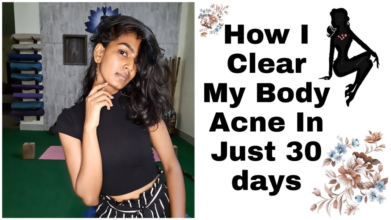 How I Clear My Body Acne In Just 30 Days | Perobar 2.5%, Cliface Gel ...