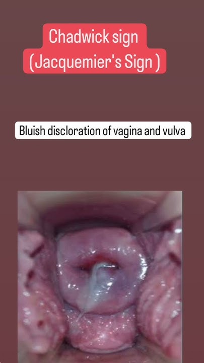 Chadwick sign. #medico #neetpg #fmge - YouTube