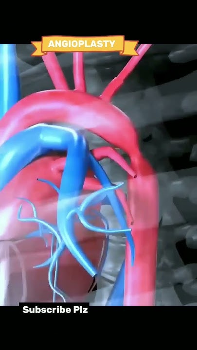 Angioplasty Heart Disorder Revolutionary 3d Animation Of Angioplasty