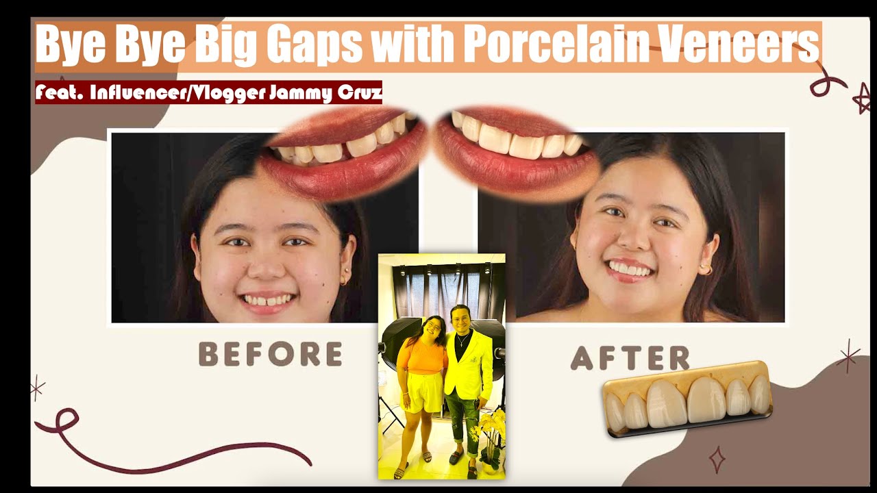 Bye Bye Big Gap for Vlogger Jammy Cruz | Emax Porcleain Veneers ...