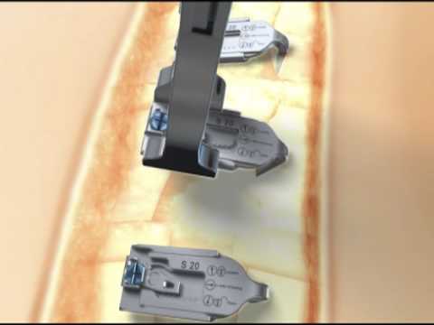 Sternal Talon® – Long term removal after bony healing - YouTube