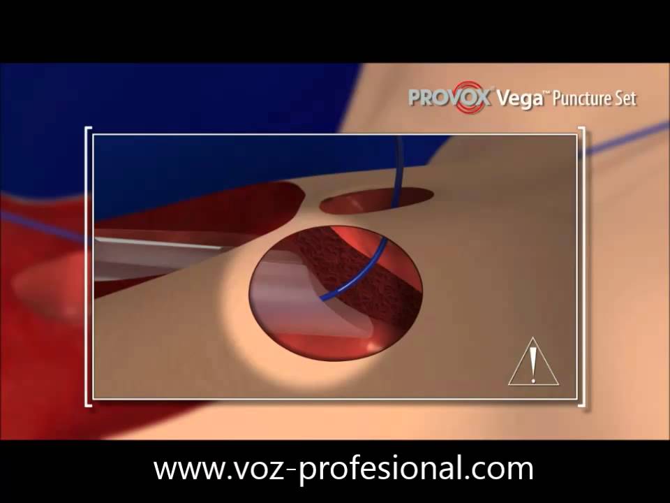 colocacion primaria de provox vega - YouTube